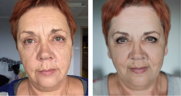 Endolifting 4D - Laserowy Facelifting | Medycyna estetyczna - Artplastica